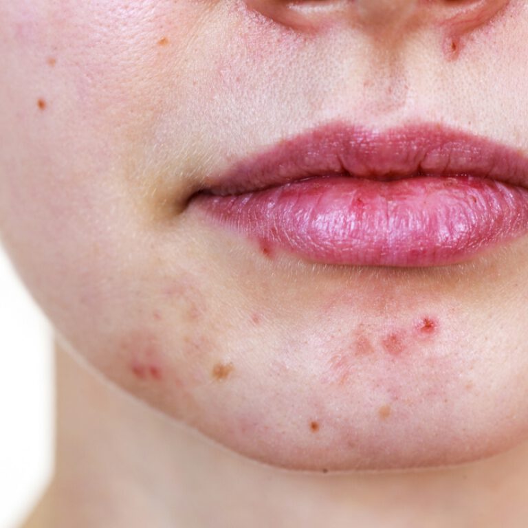 Cystic Acne Treatment | Fast Relief with Cortisone Injections | Look ...